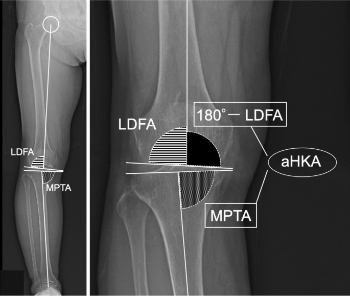 Beyond valgus stress radiography: arithmetic HKA angle (aHKA) as a ...