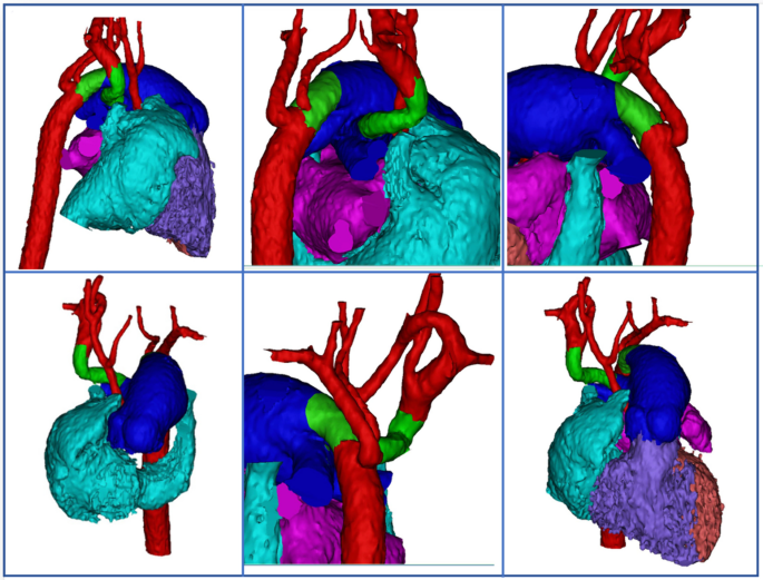 Biventricular repair in low-weight patient with interrupted aortic arch ...