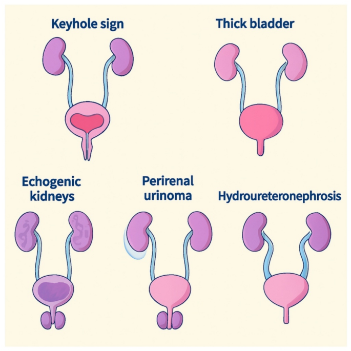 Posterior urethral valves in children: from antenatal diagnosis to long ...