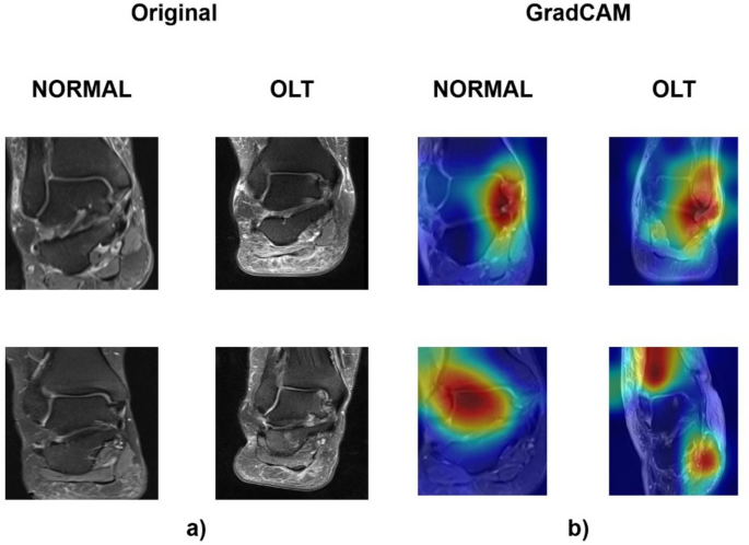 Detection of osteochondral lesion of talus in ankle magnetic resonance ...