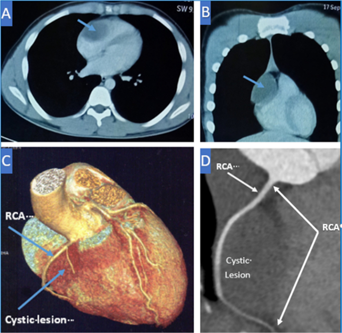 Surgical resection of a large congenital epicardial cyst encircled by ...