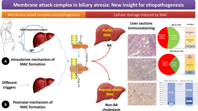 Membrane attack complex in biliary atresia: new insight for ...