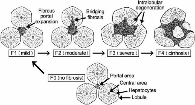 Non-alcoholic fatty liver disease in Northeast India: a narrative ...