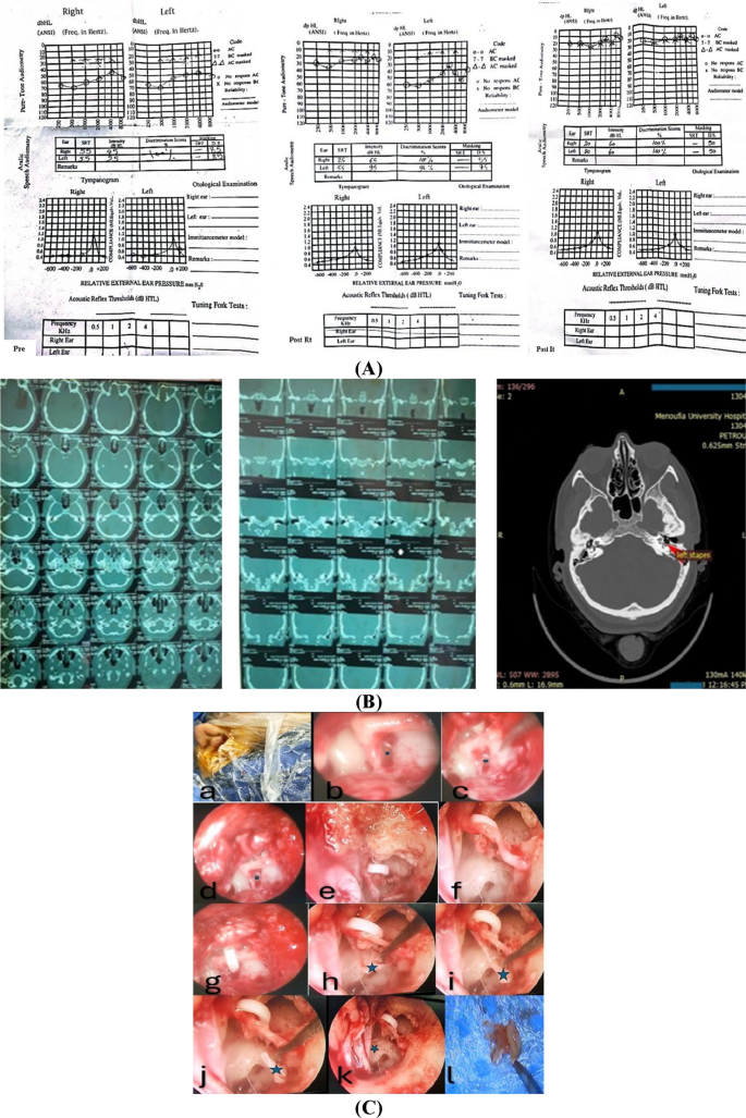 Assessment of functional outcomes after stapedotomy with and without ...