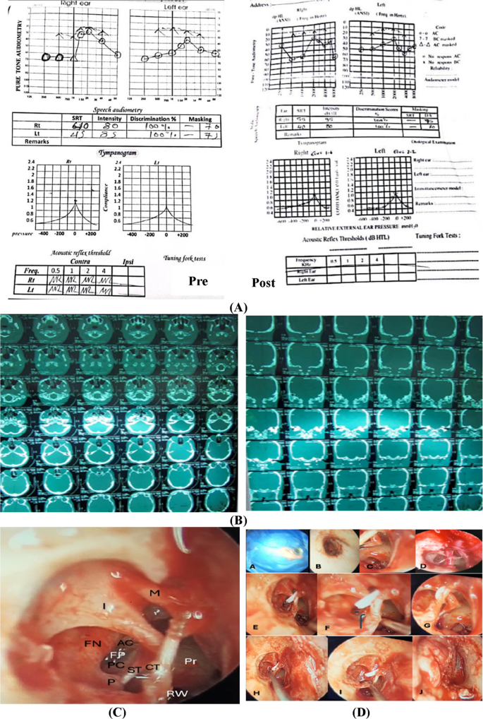 Assessment of functional outcomes after stapedotomy with and without ...