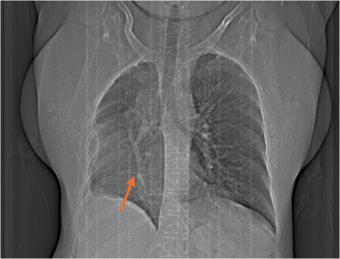 A lobe lost and a vein misplaced: an adult’s tale of scimitar syndrome ...