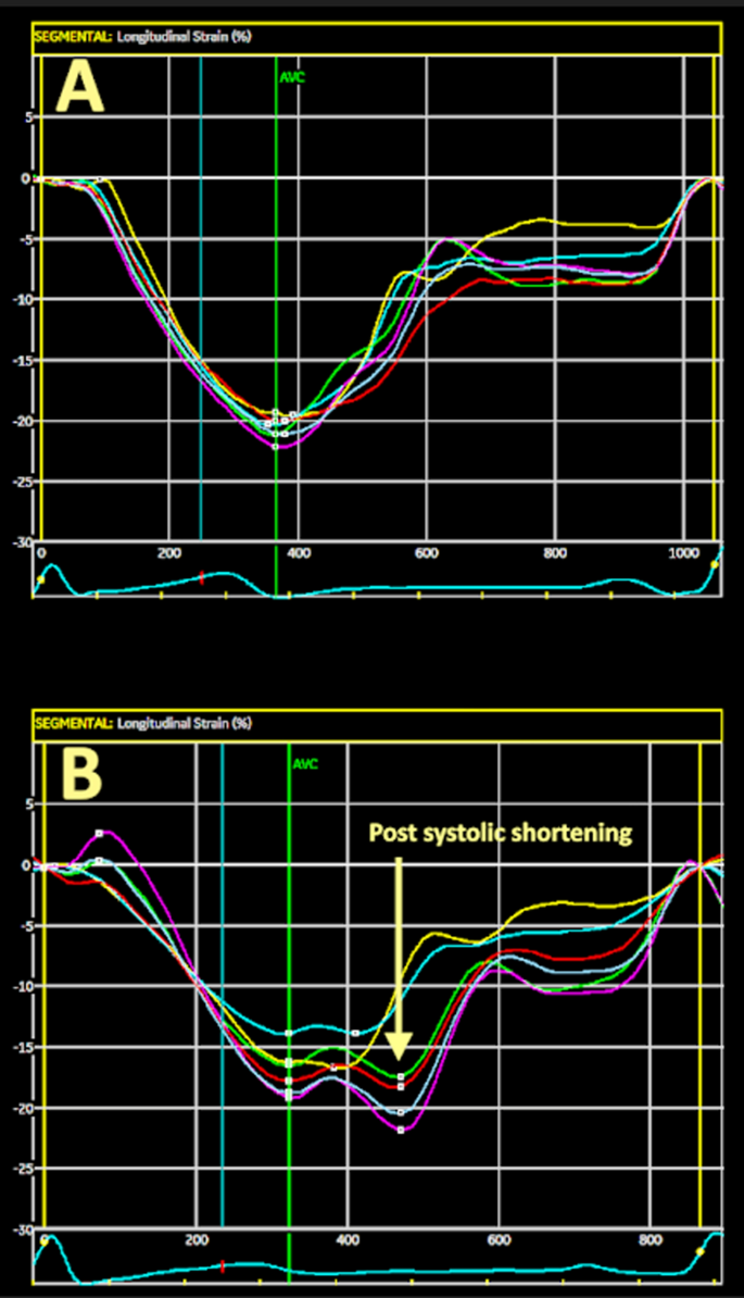 Pathological post-systolic shortening as a prognostic marker for major ...