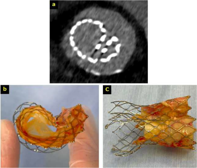 Fatal outcome after self-expanding transcatheter aortic valve ...
