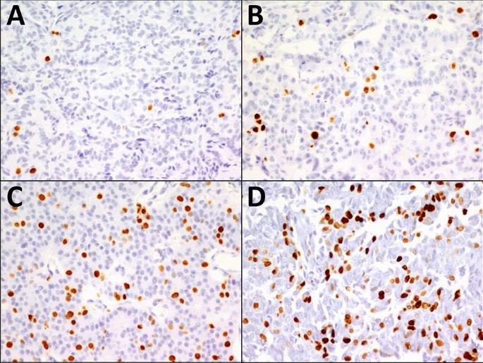 Subgrading of G2 Pancreatic Neuroendocrine Tumors as 2A (Ki67 3% to