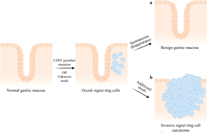 Disappearing Signet Ring Cell Adenocarcinoma in Gastric Cancer Patients ...