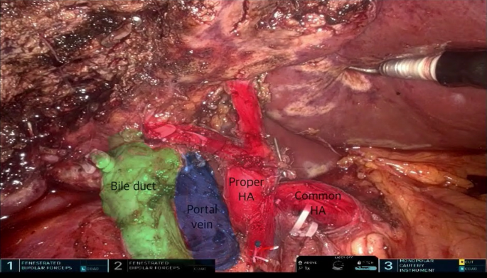 Exploring the Potential of Robotic Single-Port Surgery for Gallbladder ...