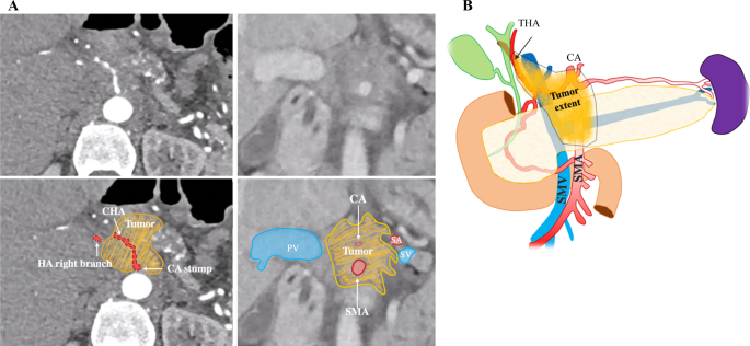 Two-Stage Mayo Clinic Class IIIb Celiac Axis Resection for Pancreatic ...