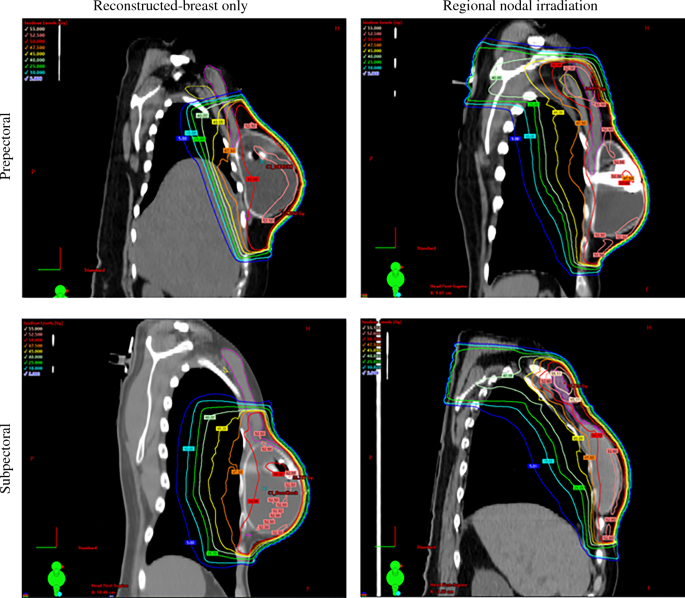Effect of Prepectoral Versus Subpectoral Implant-Based Reconstruction ...