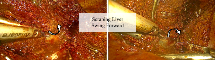 Scraping Hepatectomy Using Ultrasonic Scalpel for Complex Liver Segment ...