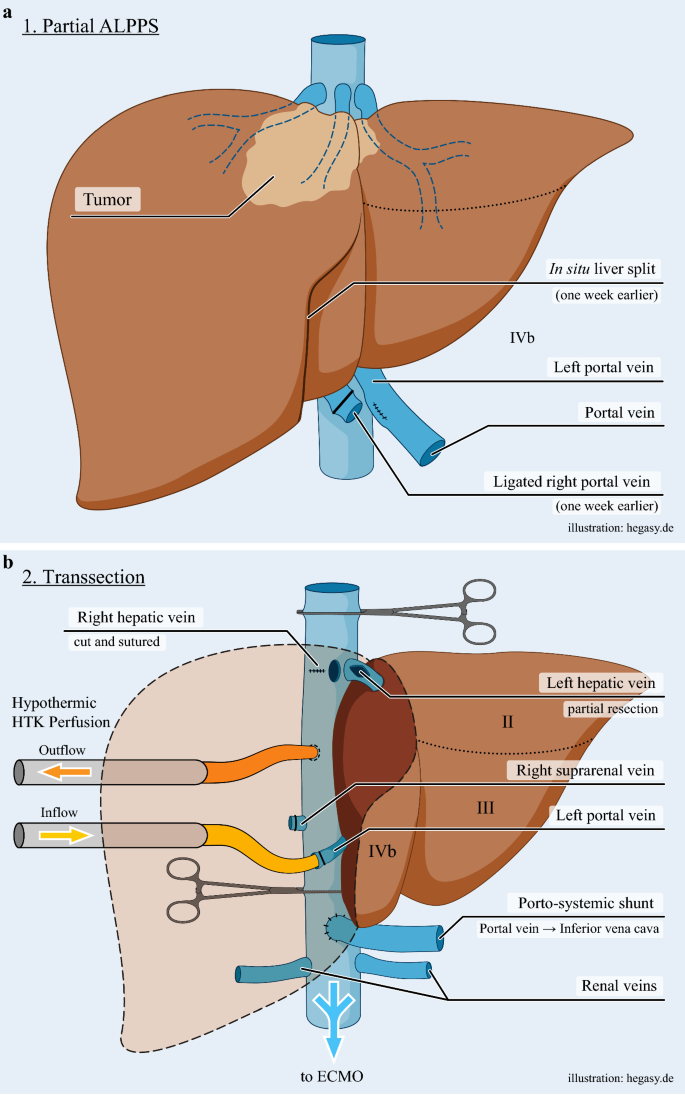 Two-Stage Hepatectomy for Cholangiocarcinoma Under Total Vascular ...