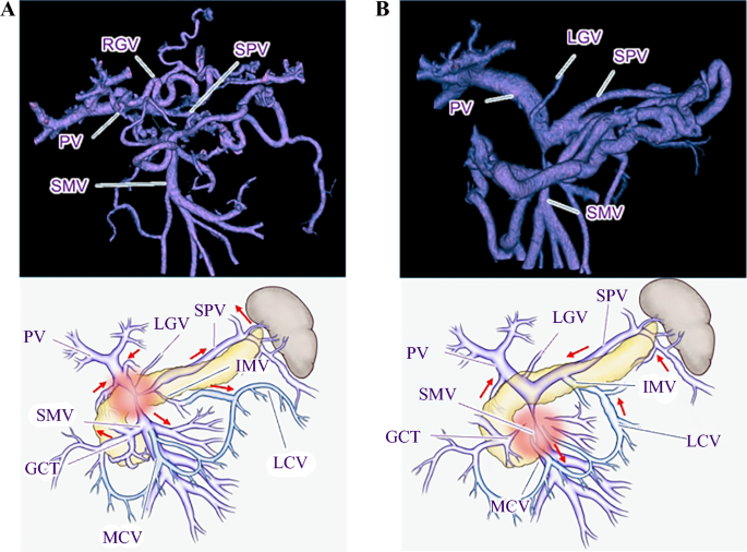 Surgical Challenges Associated with Collateral Veins Formation in ...