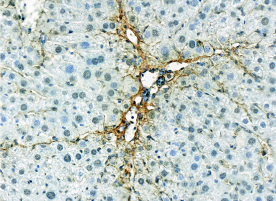 SOX9 predicts progression toward cirrhosis in patients while its loss ...
