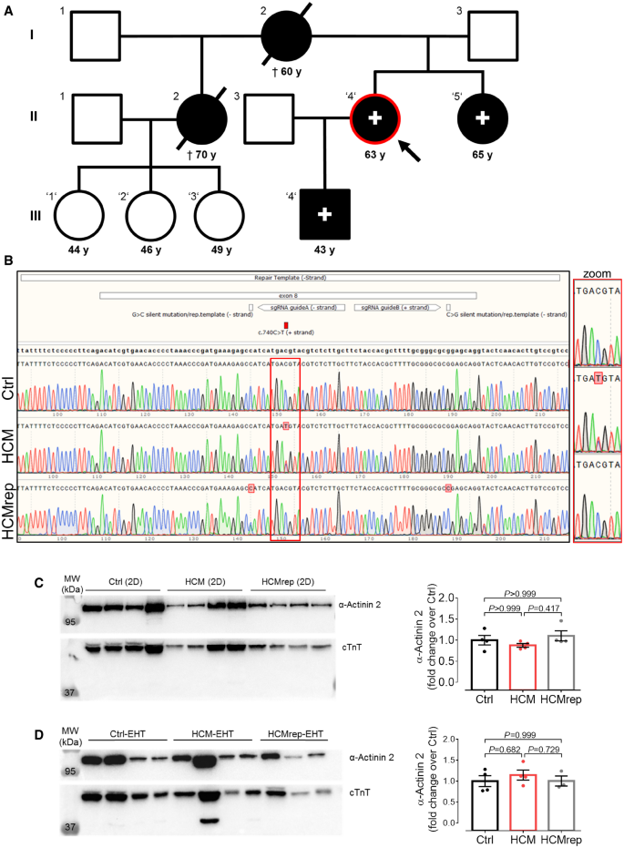 Disease modeling of a mutation in α‐actinin 2 guides clinical therapy ...