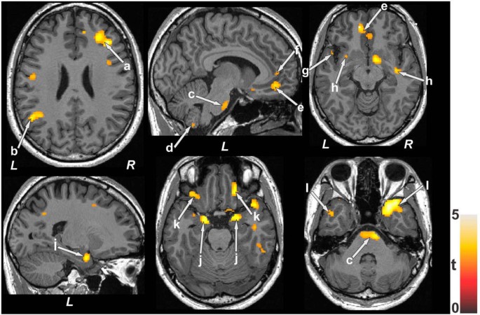 Relationships between brain tissue damage, oxygen desaturation, and ...