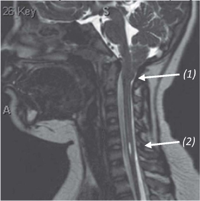 Social impairment and snoring: a unique presentation of pediatric ...