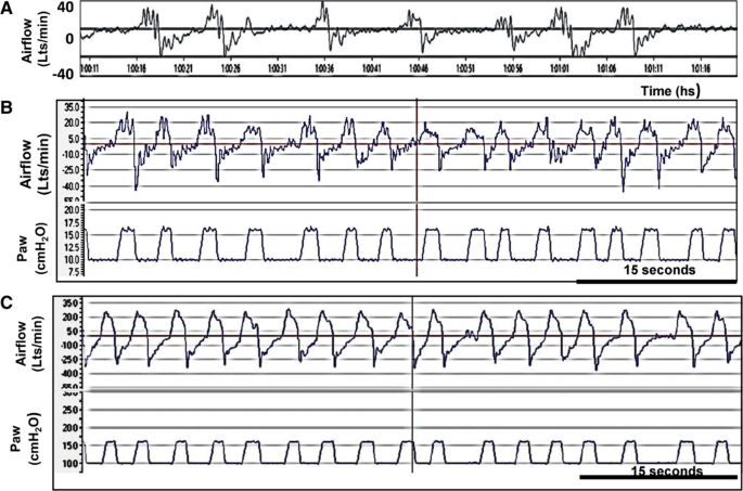 A novel presentation of diaphragmatic flutter in a patient with ...