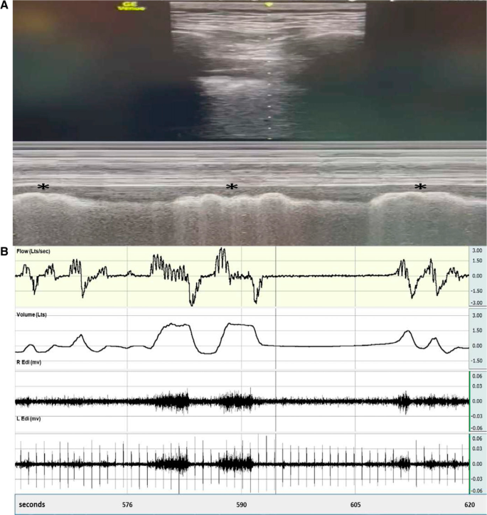 A novel presentation of diaphragmatic flutter in a patient with ...