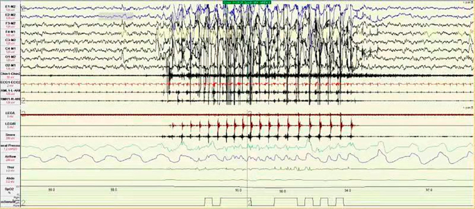 Persistent combined type sleep-related rhythmic movement disorder into ...