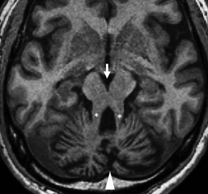 A case of middle-aged central sleep apnea due to Joubert syndrome with ...
