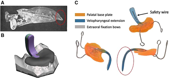 Palatal plates for treating infants with Robin sequence | Journal of ...