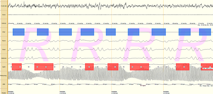 Images: Atypical resolution of sleep-related hypoventilation in ...