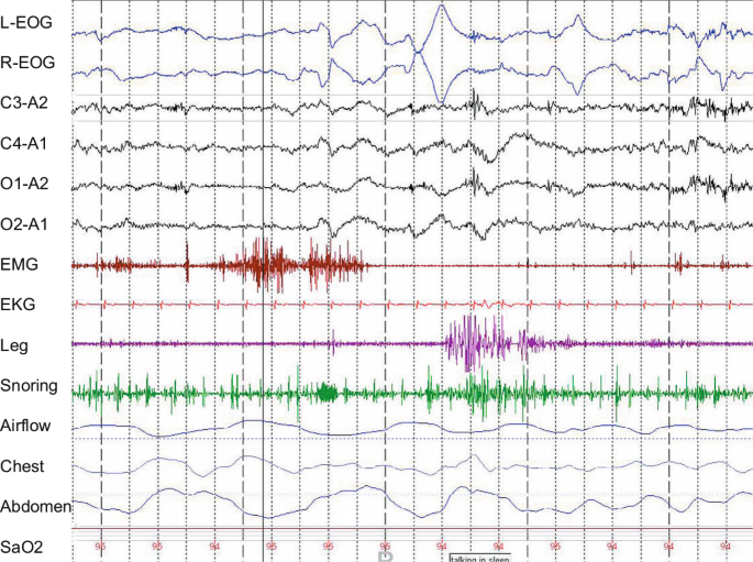 The Man Who Fought in Sleep | Journal of Clinical Sleep Medicine ...