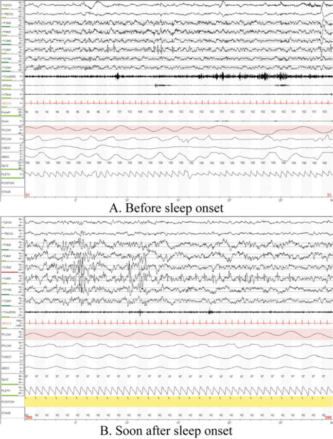 Four-Year-Old Girl with Abnormal EEG on Routine Overnight Polysomnogram ...