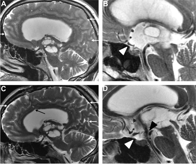 Development of a Short Sleeper Phenotype after Third Ventriculostomy in ...