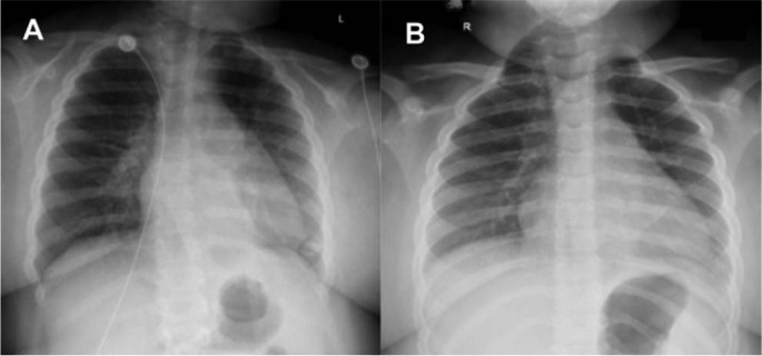 Apical Lung Herniation Associated with Continuous Positive Airway ...