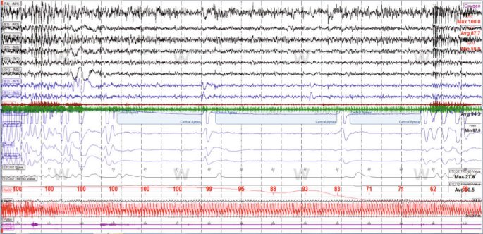 Severe Postictal Hypoxemia-Associated Seizure in a 12-Year-Old Child ...