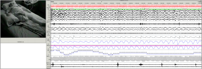 Images: Periodic Limb Movements During Sleep Noted on Ventral Thigh ...