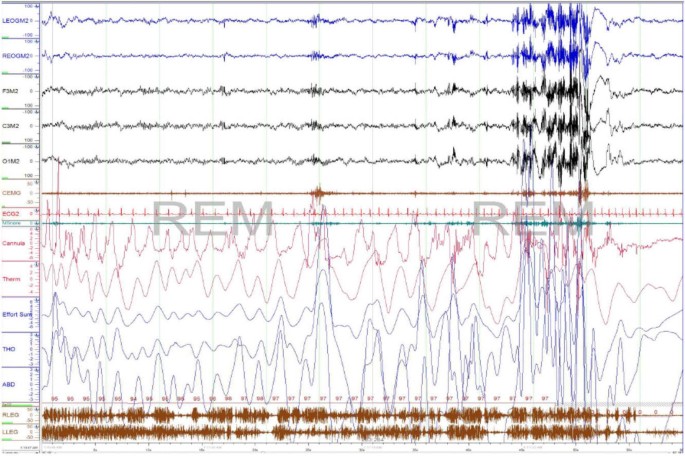 Unexpected Finding of Idiopathic REM Sleep Behavior Disorder in a Young ...