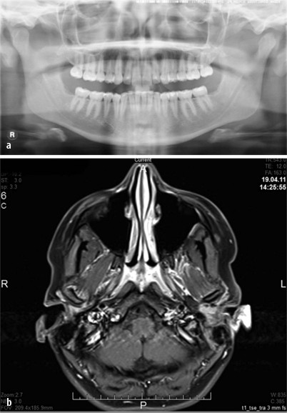 Classification of temporomandibular joint erosion, arthritis, and ...
