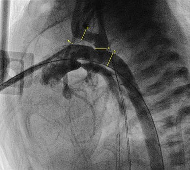 Predictors of Retrograde Aortic Arch Obstruction After Hybrid ...