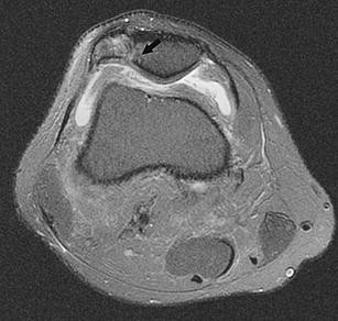The patellar extensor apparatus of the knee | SpringerLink