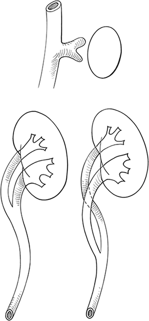 The duplicated collecting system of the urinary tract: embryology ...