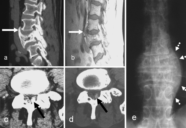 The spine in Paget’s disease | SpringerLink