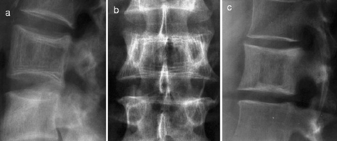 The spine in Paget’s disease | Skeletal Radiology | Springer Nature Link