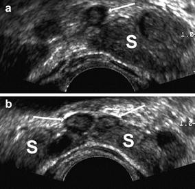 Hematospermia: imaging findings | SpringerLink
