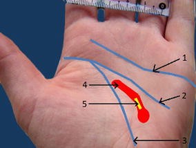 Can palmar creases serve as landmarks for the deeper neuro-vascular ...