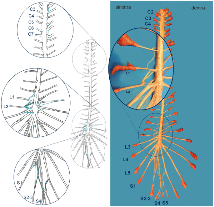 Intraspinal intradural variations of nerve roots | SpringerLink