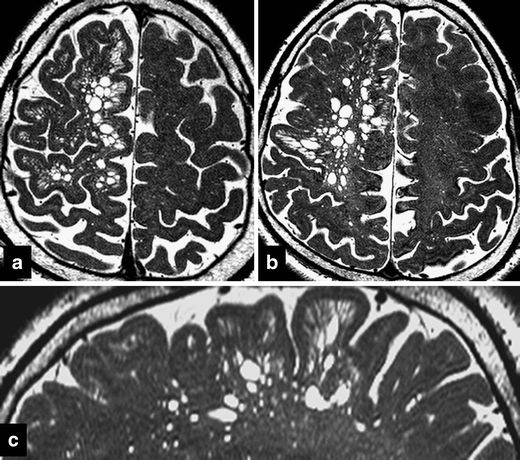 The Virchow-Robin spaces: delineation by magnetic resonance imaging ...