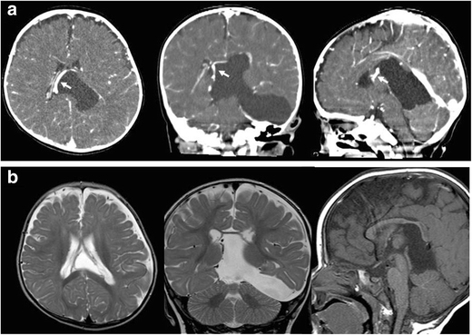 Pediatric intraventricular arachnoid cysts in the body of lateral ...
