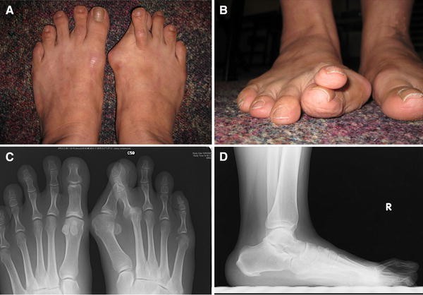 Correction of crossover deformity of second toe by combined plantar ...