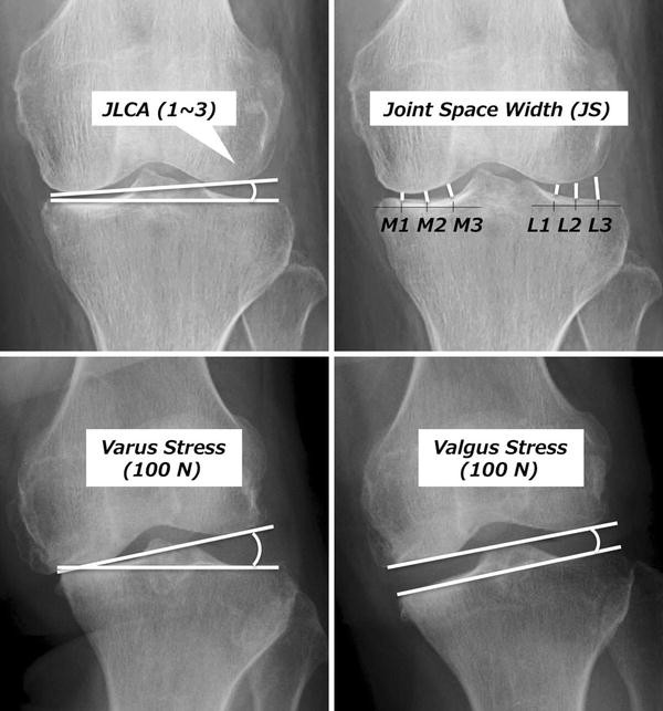 Tibial condylar valgus osteotomy (TCVO) for osteoarthritis of the knee ...